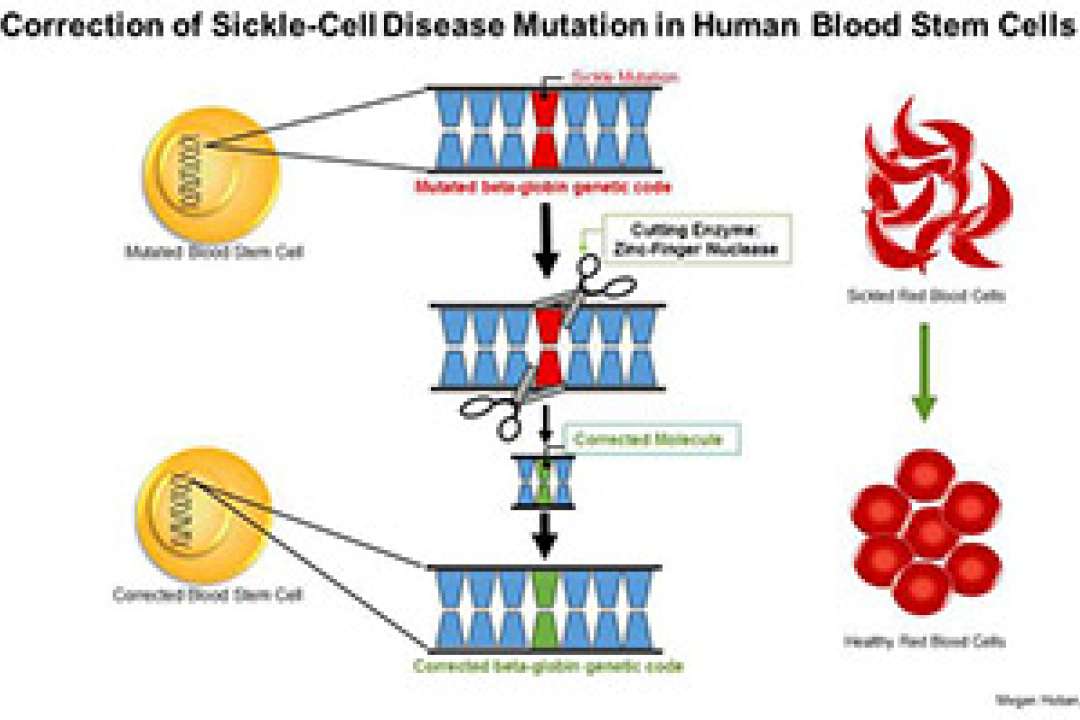 UCLA stem cell researchers develop promising method to treat sickle cell disease | UCLA Health