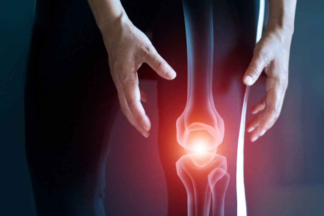 Pain in knee suggests mild MCL injury | UCLA Health
