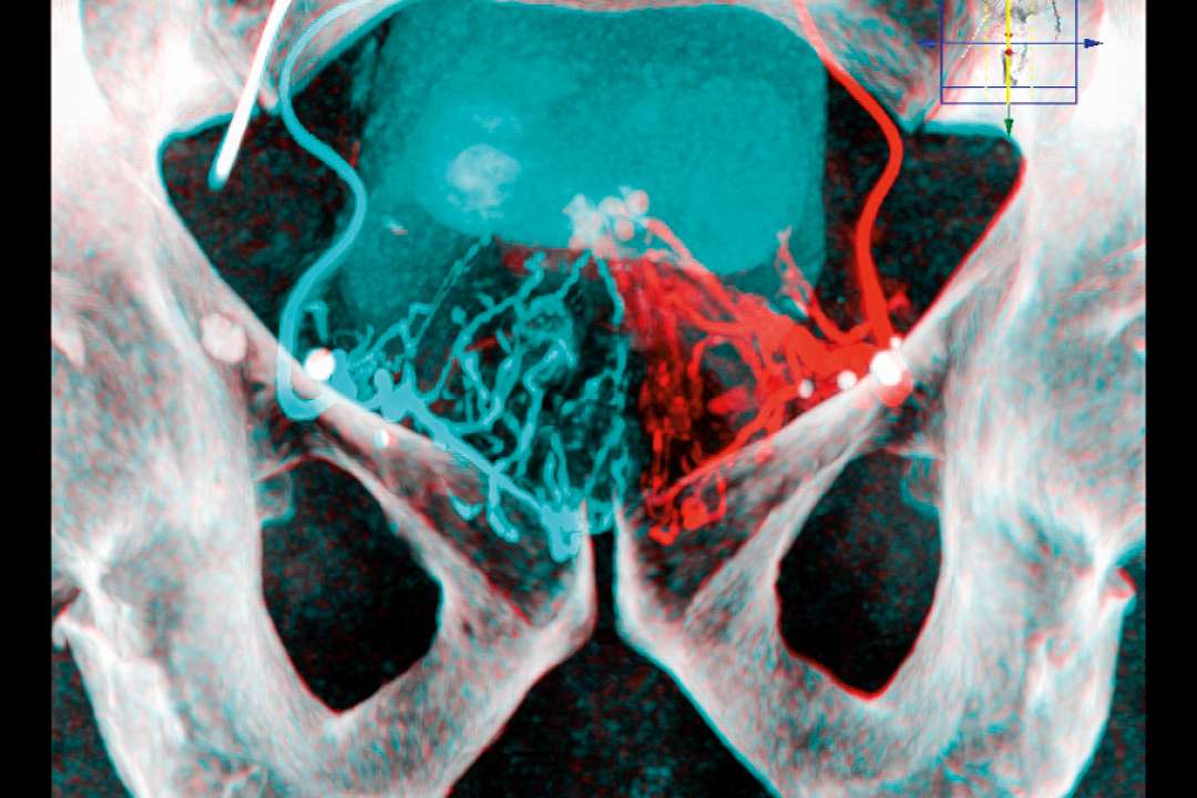 UCLA Health offers minimally invasive procedure to treat common ...