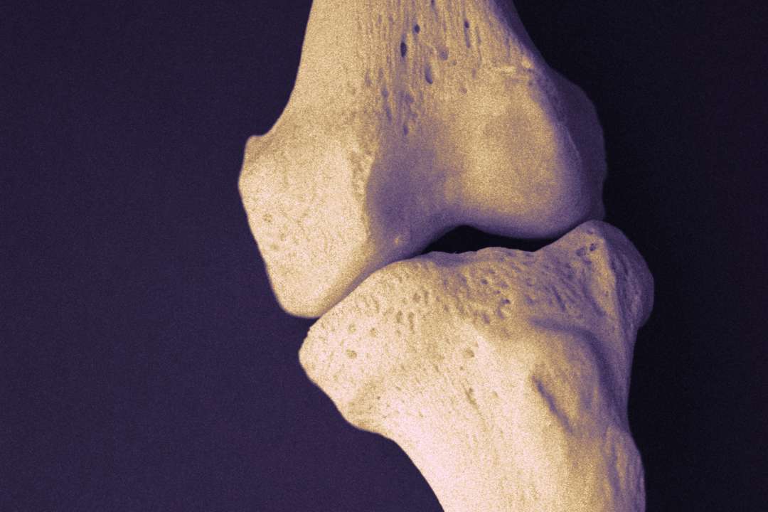 Cartilage loss increases joint friction | UCLA Health