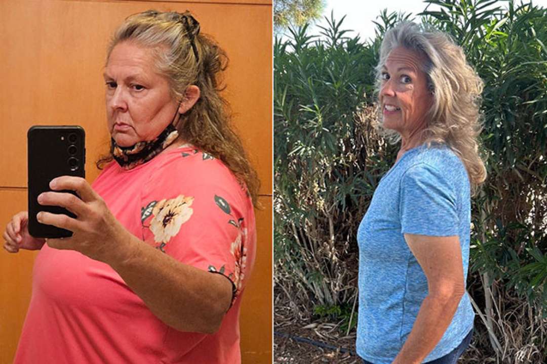 Gastric Sleeve, Sleeve Gastrectomy, VSG (Vertical Sleeve Gastrectomy ...