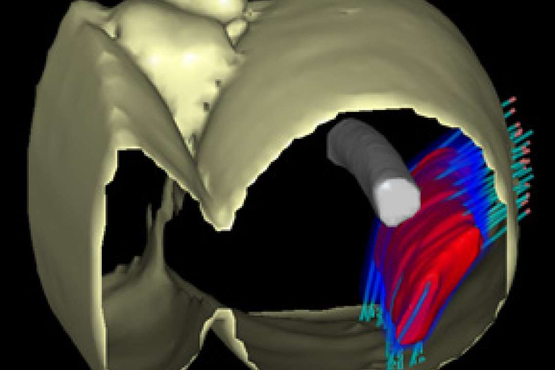 ASTRO: Optimizing preoperative radiation therapy in high-risk sarcoma ...
