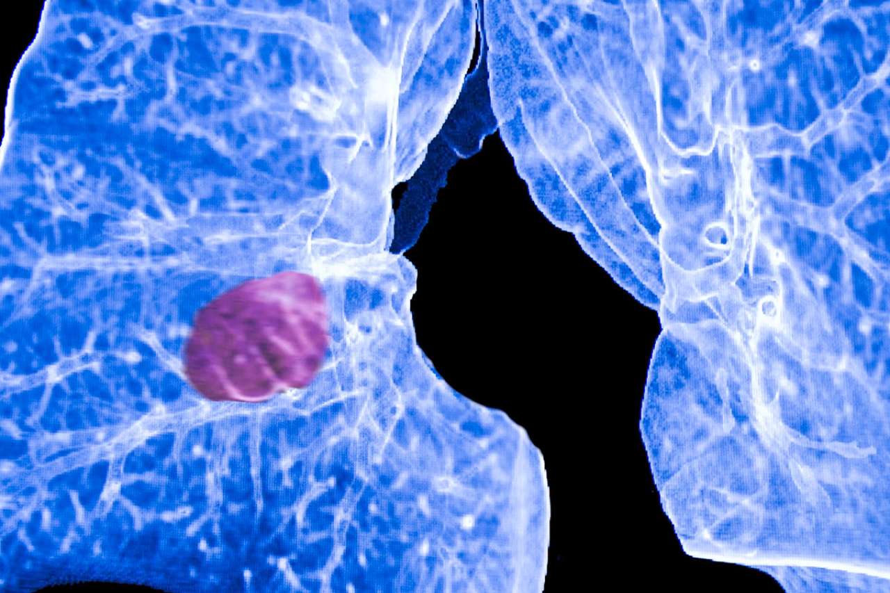 Researchers Develop Model that May Help Identify Lung Cancer Stem Cells ...