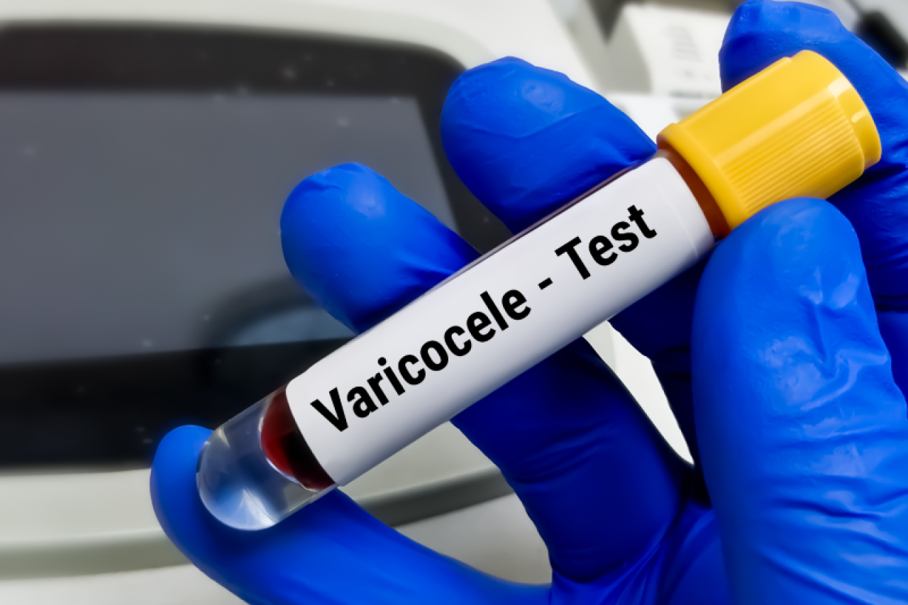 UCLA Health research focuses on varicoceles and male fertility | UCLA ...