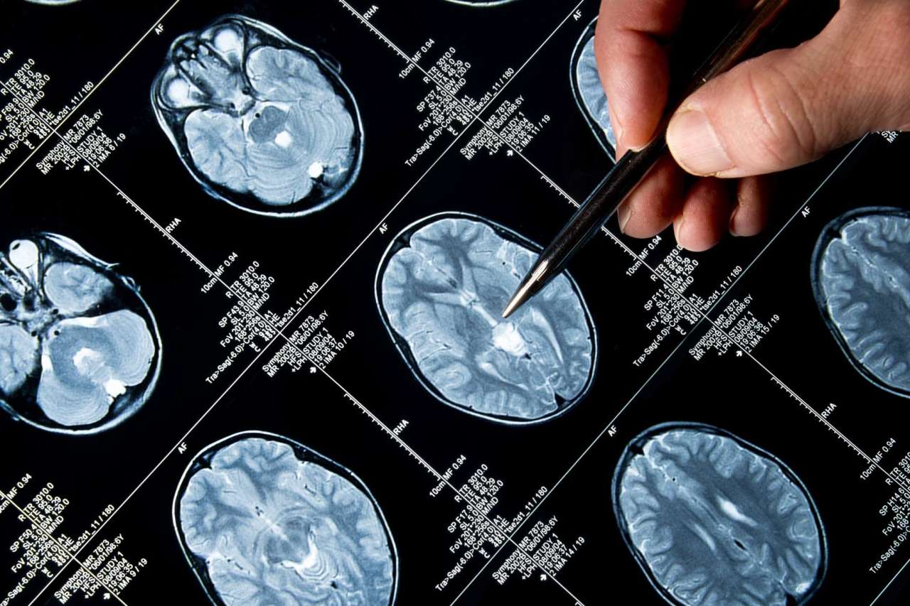 A dime-size buzzer on the foot could reduce epileptic seizures | UCLA ...