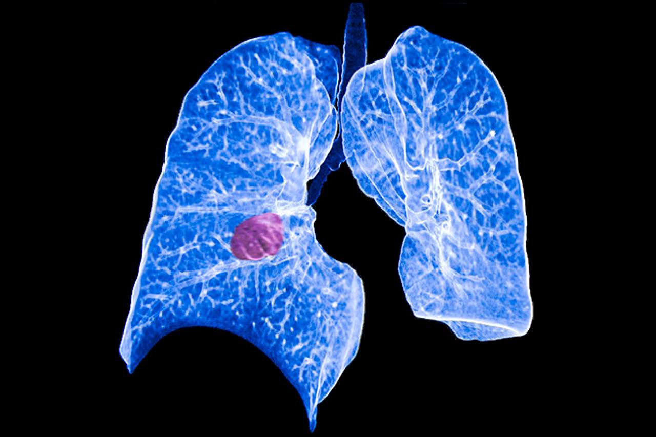 Lung cancer screening offers early detection | UCLA Health