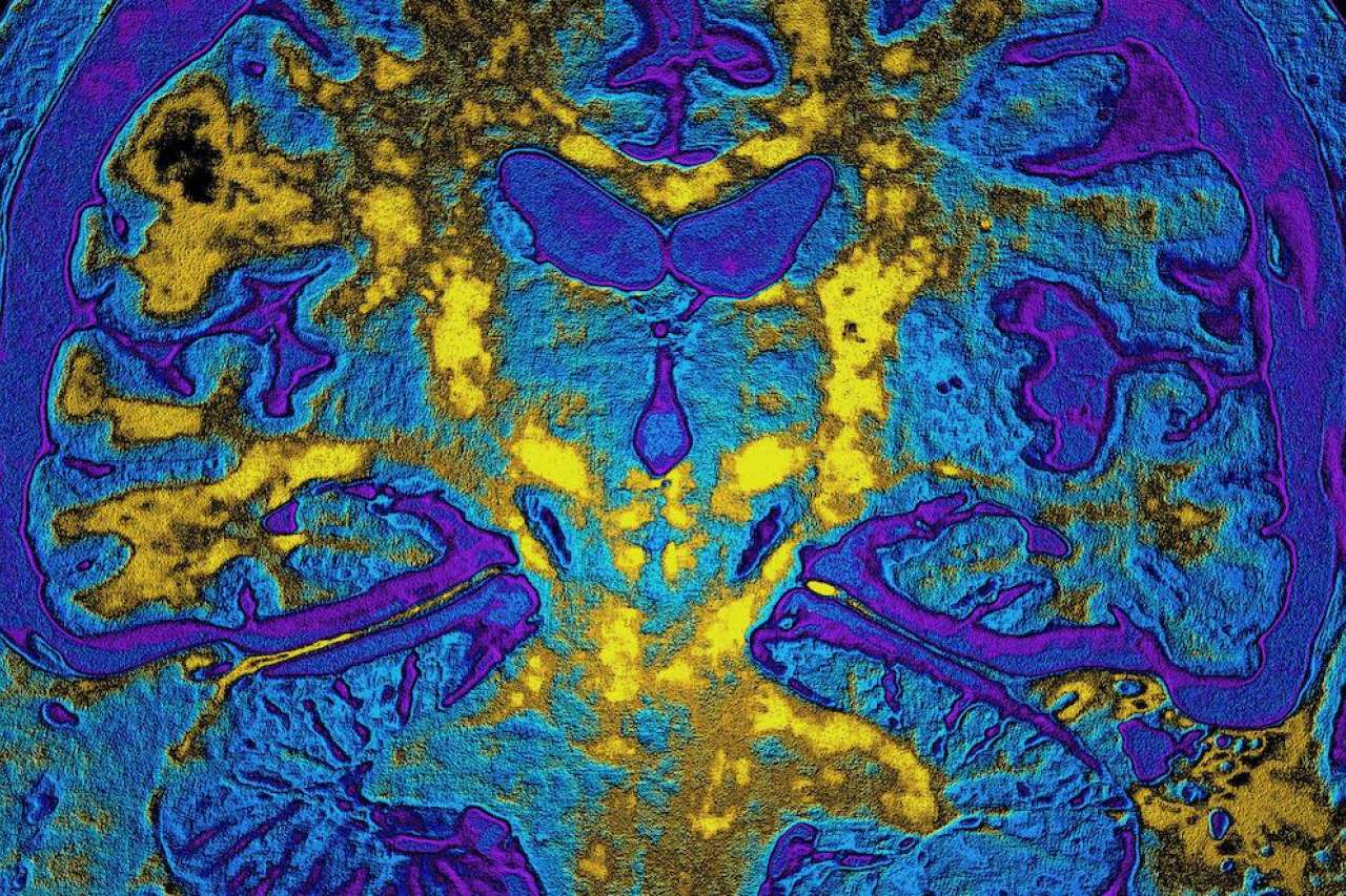 New blood test reads messages from the brain | UCLA Health