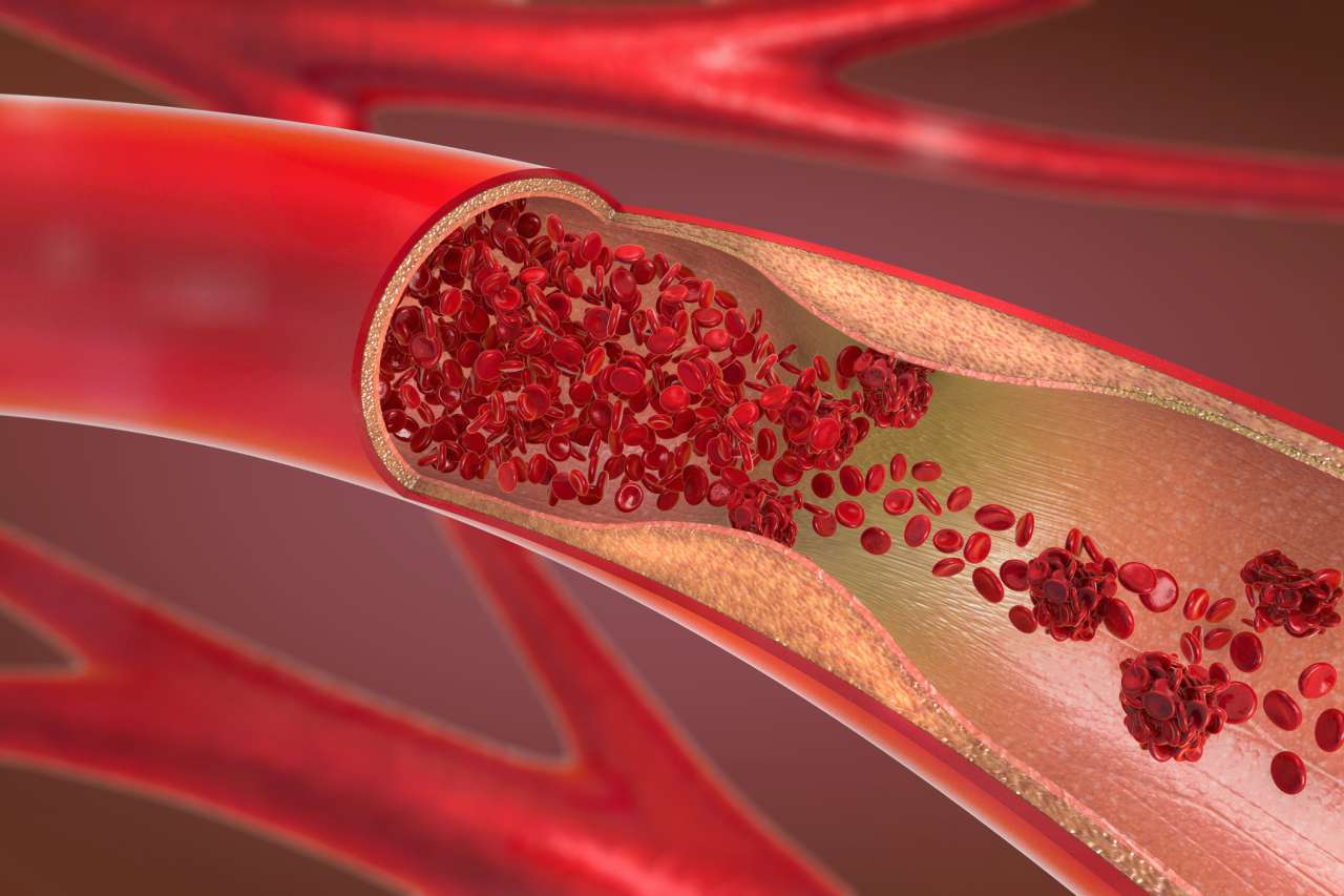 Smoking a huge risk factor for peripheral artery disease | UCLA Health