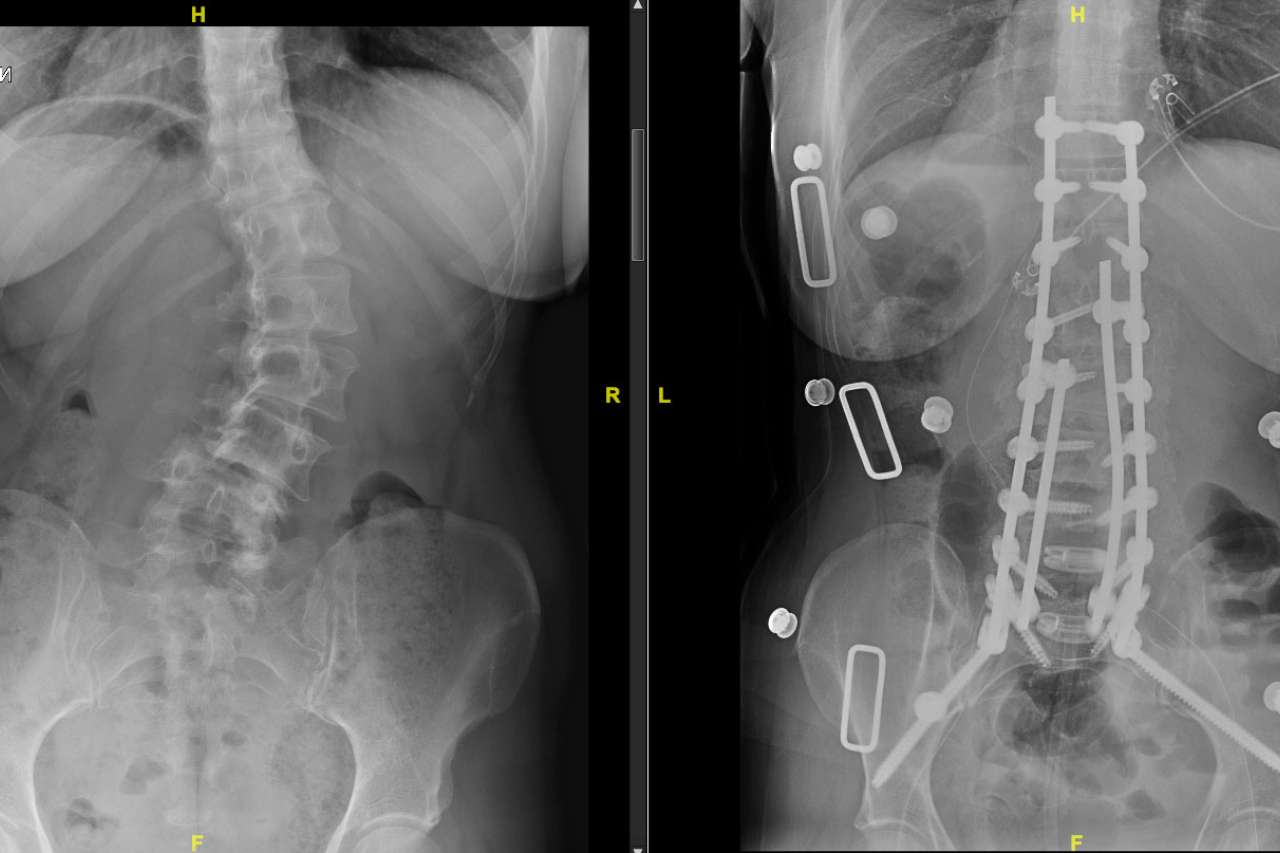 Advances in spine surgery open the door to relief for a broader ...