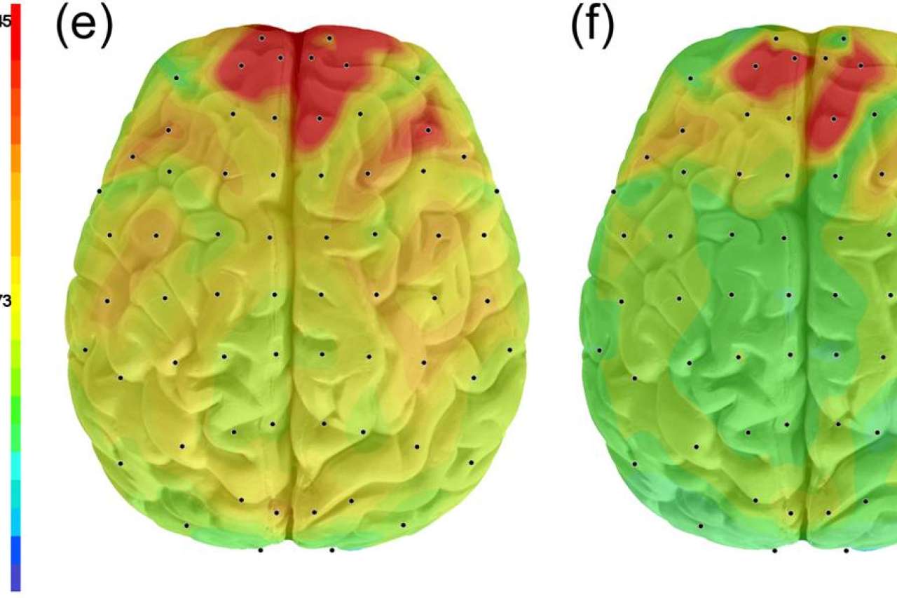 Hyperactivity in brain may explain multiple symptoms of depression ...