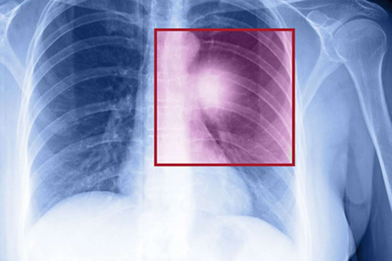 Immunotherapy improves five-year survival rate of people with advanced ...