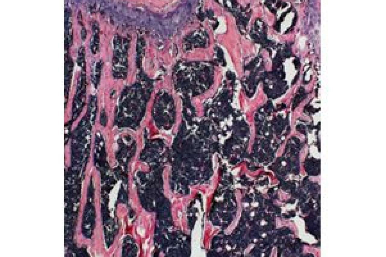 Researchers discover gene that slows bone loss and promotes bone ...