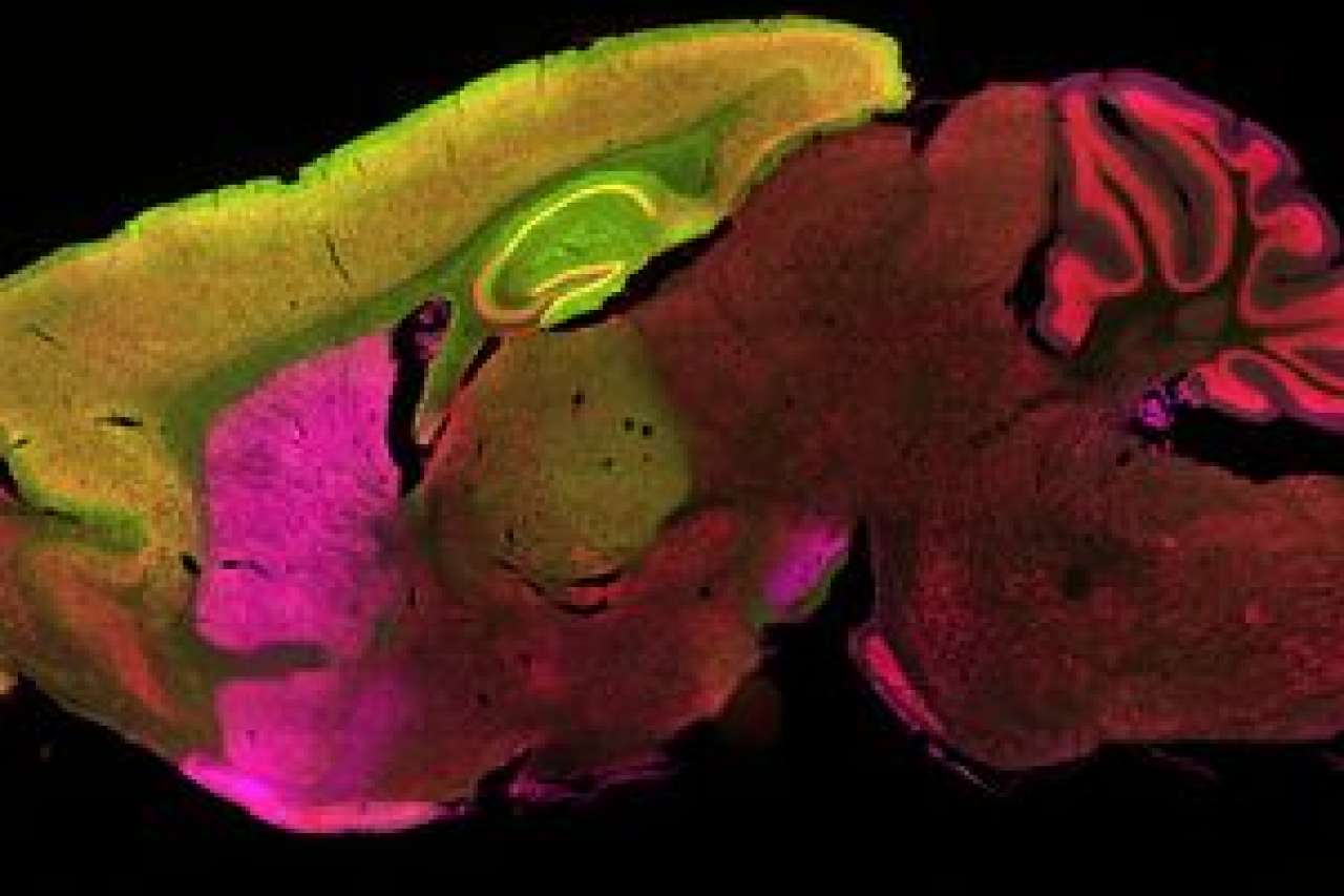 UCLA scientists hunt down origin of Huntington's disease in the brain ...