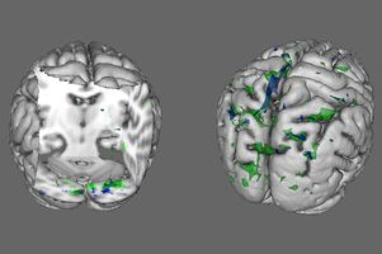 UCLA study shows that people with anorexia and body dysmorphic disorder ...
