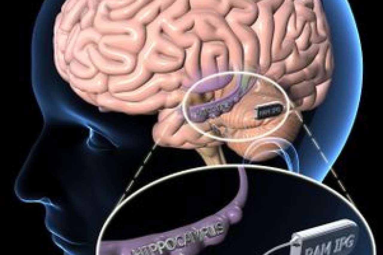 UCLA to develop 'brain prosthesis' to help brain-injured patients ...