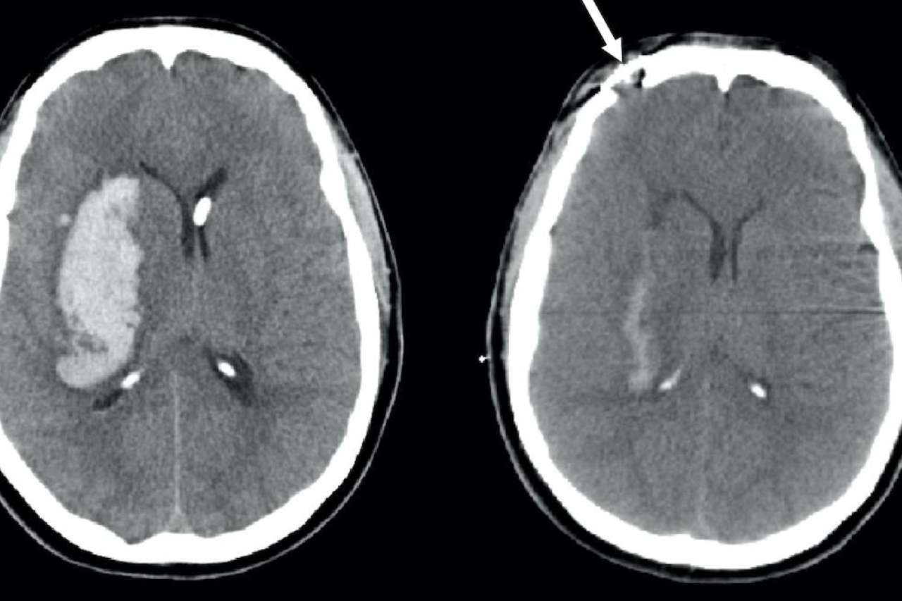 How do brain cells compensate for damage from a stroke? | UCLA Health