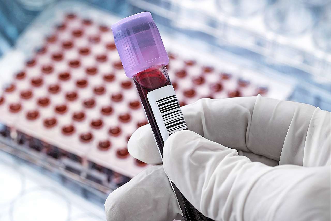 Study supports new blood-based biomarker to detect early brain changes ...