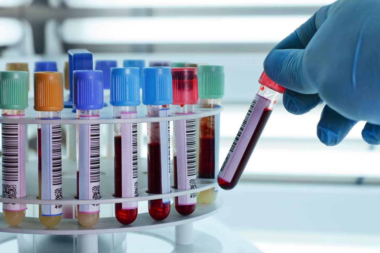 Blood tests show potential for colorectal cancer detection, but follow ...