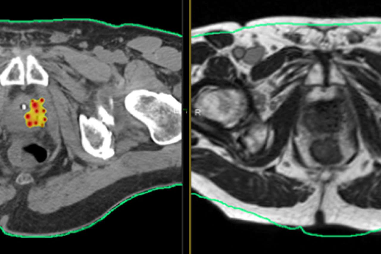 UCLA Scientists for the First Time Identify Cell of Origin for Human ...