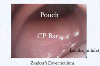 Zenker's Diverticulum - Head & Neck Surgery | UCLA Health