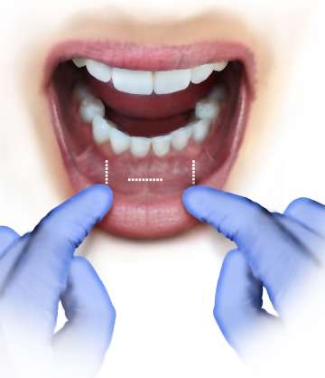 Scarless Thyroid Surgery - TOETVA Procedure - Endocrine Surgery | UCLA ...