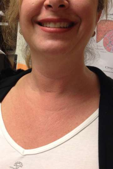 Parathyroidectomy Scar Photos - Parathyroid Surgery Scar Photos ...
