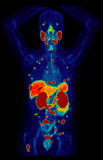 Theranostics | UCLA Health