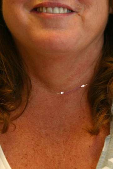 Parathyroidectomy Scar Photos - Parathyroid Surgery Scar Photos ...