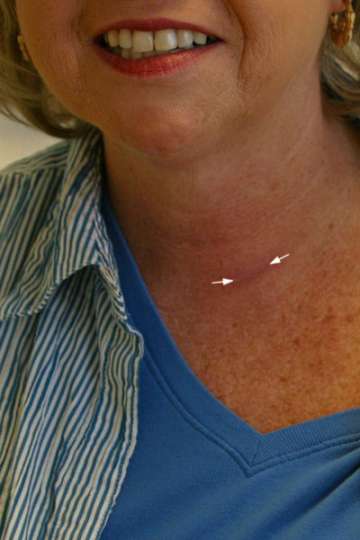 Parathyroidectomy Scar Photos - Parathyroid Surgery Scar Photos ...