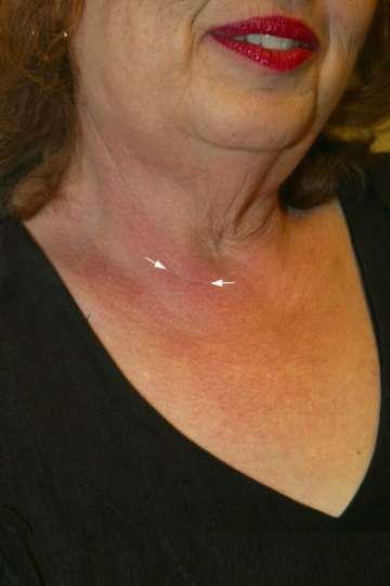 Parathyroidectomy Scar Photos - Parathyroid Surgery Scar Photos ...