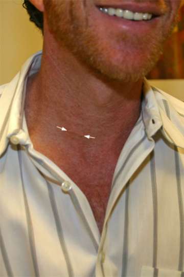 Parathyroidectomy Scar Photos - Parathyroid Surgery Scar Photos ...