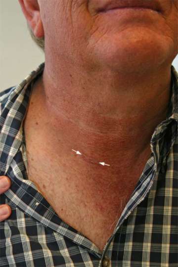 Parathyroidectomy Scar Photos - Parathyroid Surgery Scar Photos ...