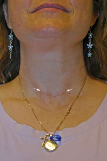 Thyroidectomy Scar Photos - Thyroid Cancer Surgery Scars - Endocrine ...