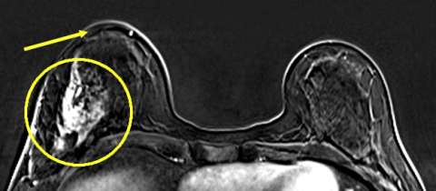 Case: Skin Retraction, Skin Thickening, and Nipple Retraction/Inversion ...