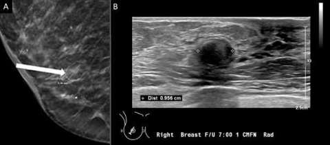 Mammography: Masses - Radiology | UCLA Health