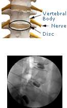 Discography - Spine Care | UCLA Health