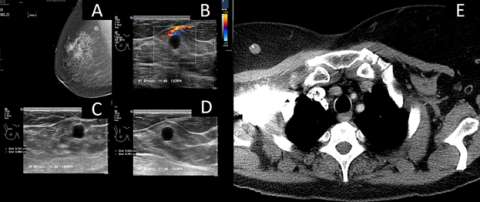 Case Metastasis to the breast from a non-breast primary cancer ...