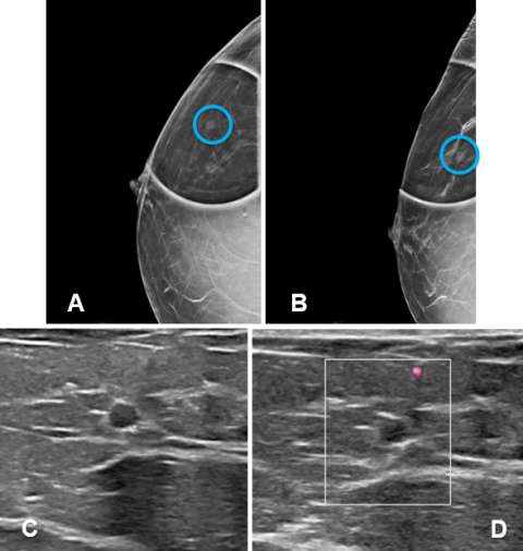 Simple Cyst, Clustered Microcysts, Complicated Cyst - Radiology | UCLA ...