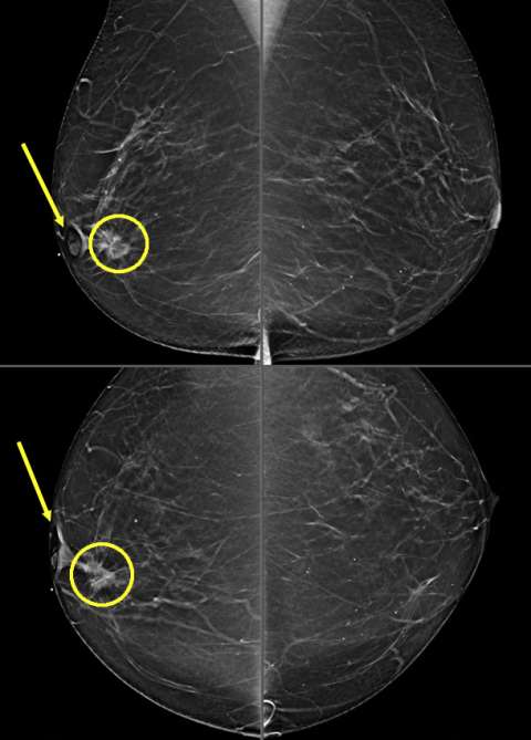 Case: Skin Retraction, Skin Thickening, and Nipple Retraction/Inversion ...