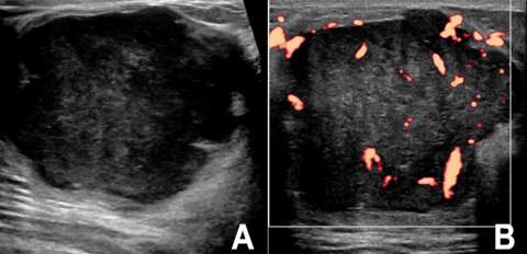 Case: Sarcoma - Radiology | UCLA Health