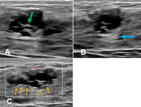 Simple Cyst, Clustered Microcysts, Complicated Cyst - Radiology | UCLA ...