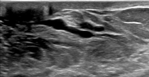 Breast Ductal Anatomy and Function - Radiology | UCLA Health