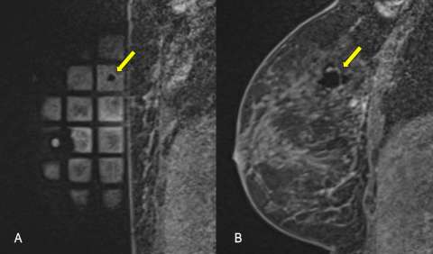 How to Perform an MRI Guided Breast Biopsy - Radiology | UCLA Health