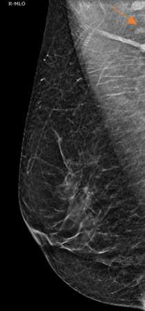 Axillary Lymphadenopathy - Radiology | UCLA Health