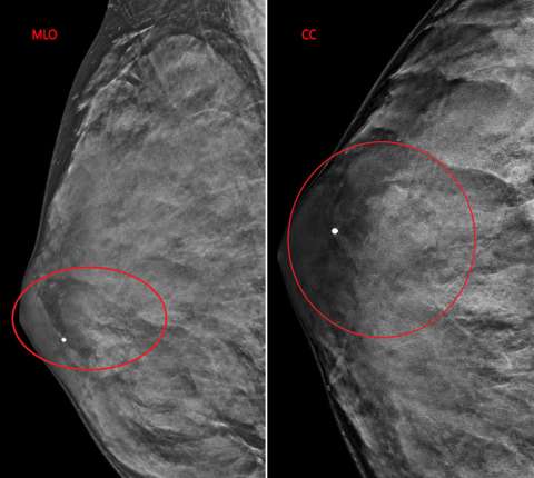 Case: Breast Imaging in Female Transgender (Male-to-Female) Patients ...