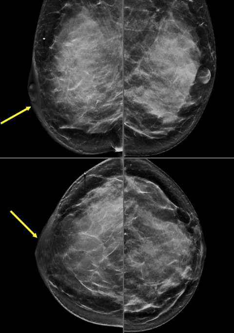 Case: Skin Retraction, Skin Thickening, and Nipple Retraction/Inversion ...
