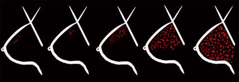 Mammography: Calcifications - Radiology | UCLA Health