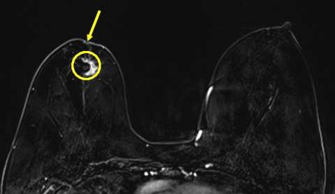 Case: Skin Retraction, Skin Thickening, and Nipple Retraction/Inversion ...