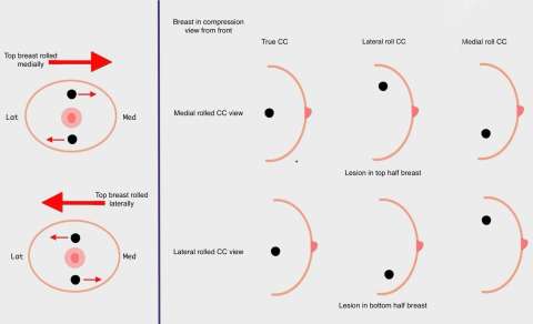Breast Lesion Localization - Radiology | UCLA Health