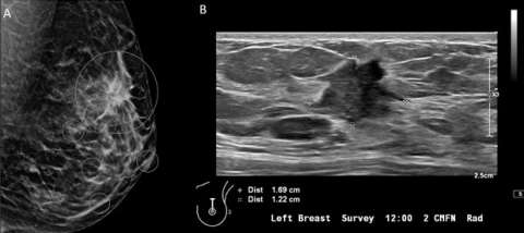 Mammography: Masses - Radiology | UCLA Health